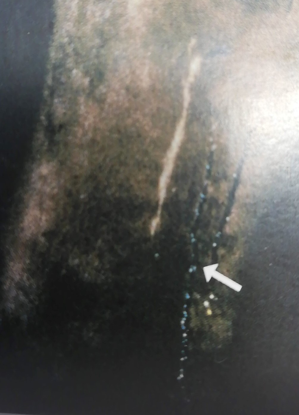 Lymphorrhea – Chronic Progressive Lymphoedema