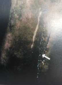 Lymphorrhea – Chronic Progressive Lymphoedema